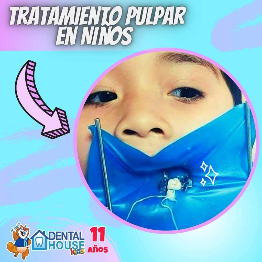 Pulpectomía “Endodoncia para niños” | Dental House Kids